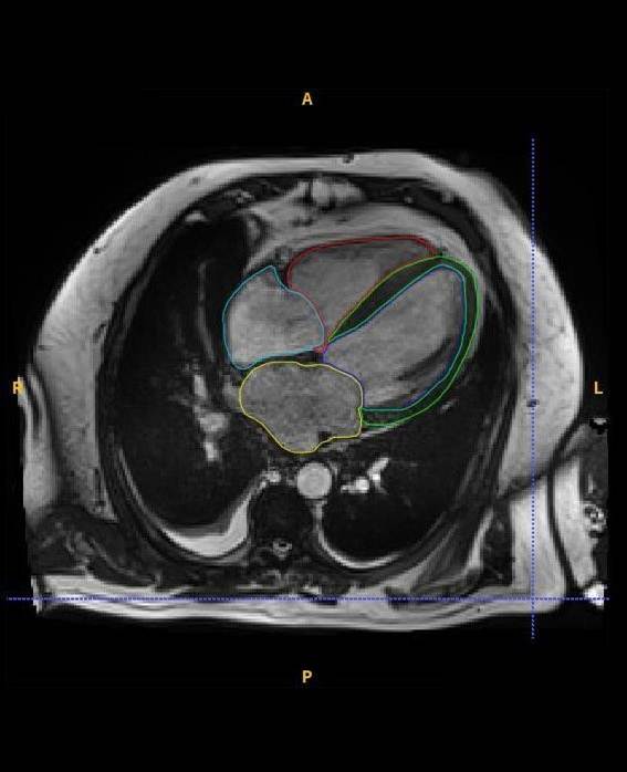 MRI 3D Modeling - ingedata