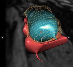 MRI 3D Modeling - ingedata