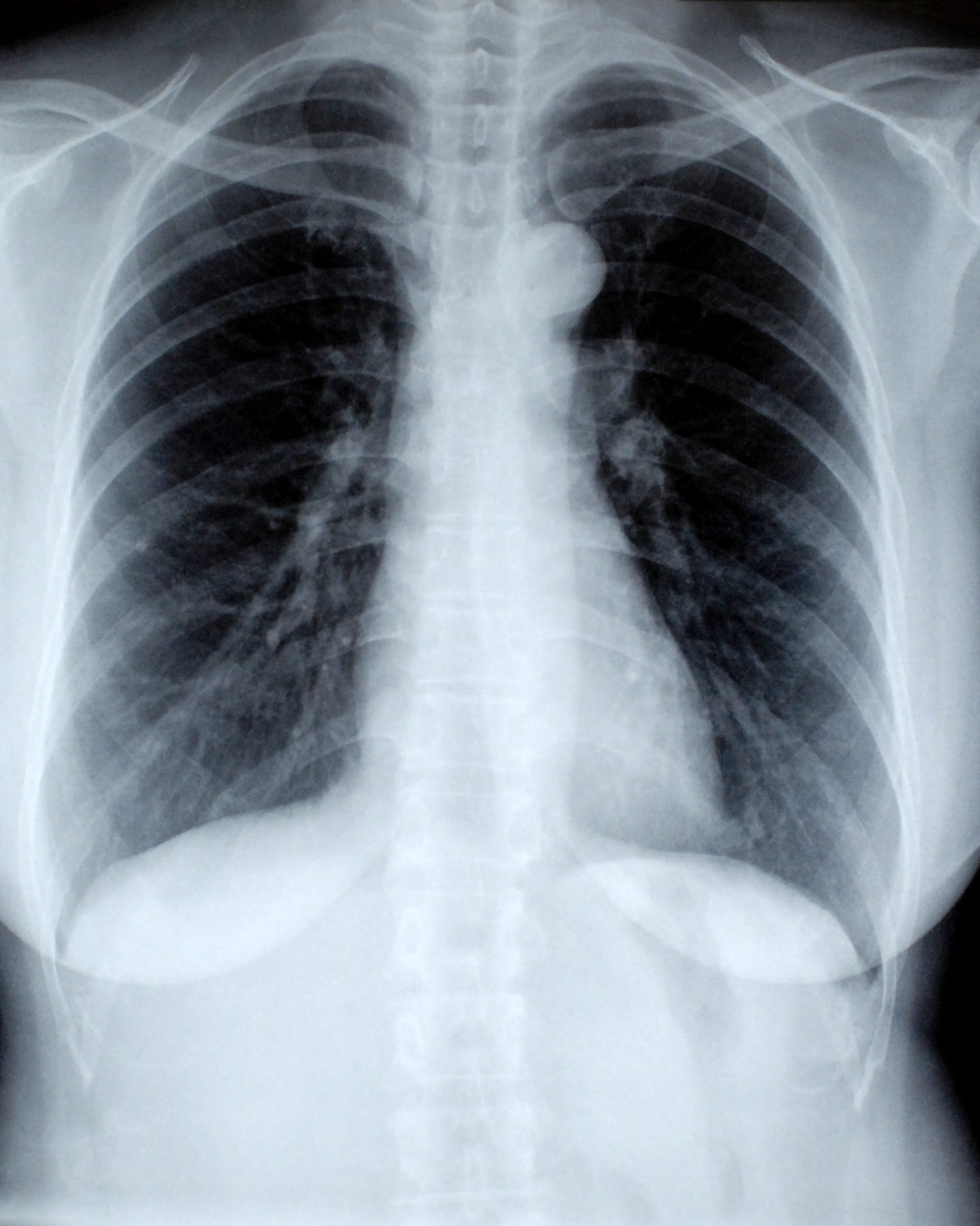 Rib Fractures on Frontal Chest X-rays - ingedata